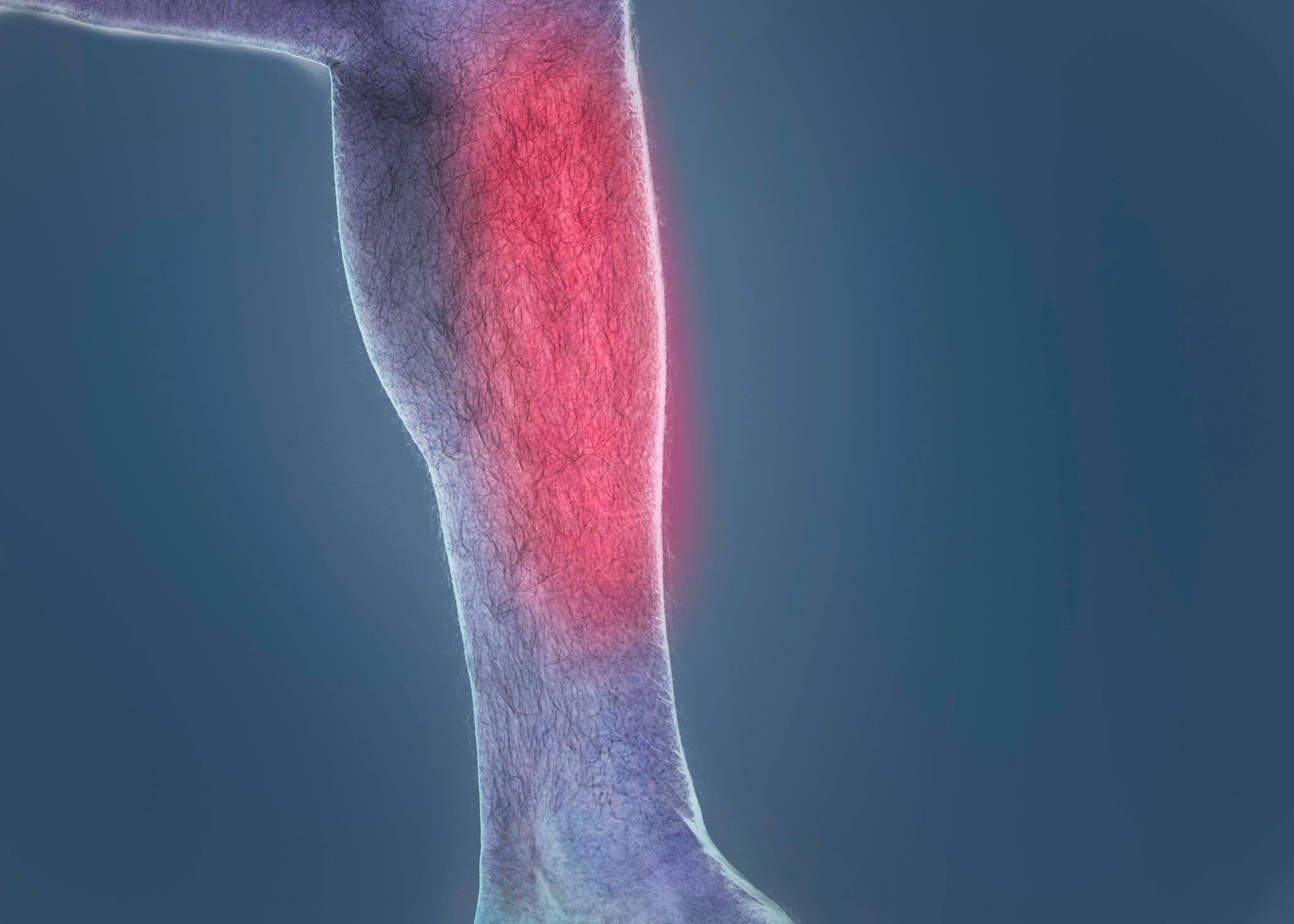 Shin splints | Prevention & compression treatment